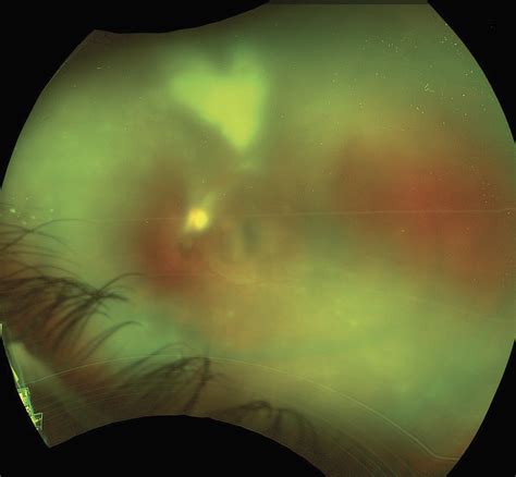 An Atypical Presentation Of Ocular Toxoplasmosis