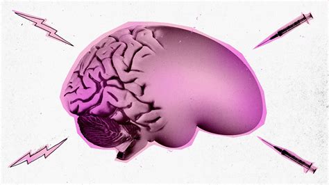 Botox For Migraine Its A Very Effective Treatment Gq