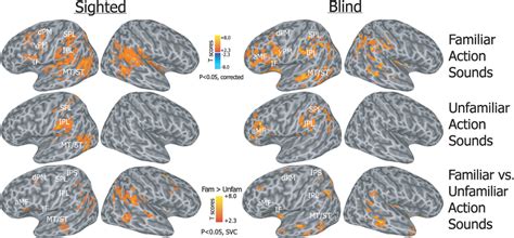 Statistical Maps Showing Brain Regions Activated During Listening To
