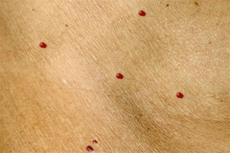 Qué Son Los Puntos Rojos En La Piel Y Por Qué Aparecen