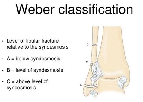 Weber A Fracture Fracture De Weber A Ifkucg