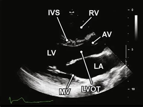 Pocus Cardiac Views Cardio Guide