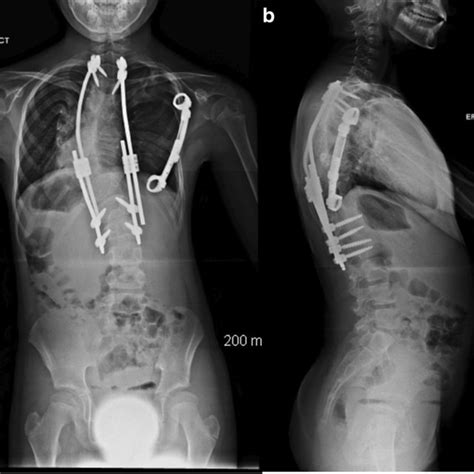 Classification Scheme Of The Various Presentations Of Hemivertebrae