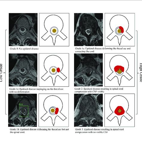Bilsky Classification Of Metastatic Epidural Spinal Cord Compression