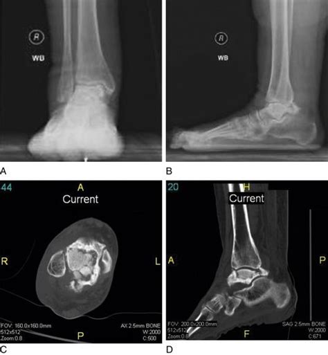 Salvage Of Ankle Large Bony Defect With Spinal Cage Clinical Tree