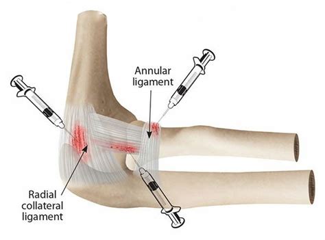 Elbow Injection And Nerve Compression In The Elbow