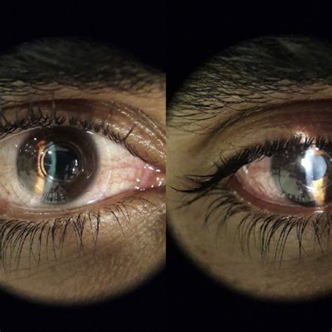 Hybrid Lens On The Eye Download Scientific Diagram