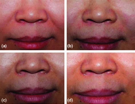 Photographs Of Nasolabial Folds Of A Representative Patient With A