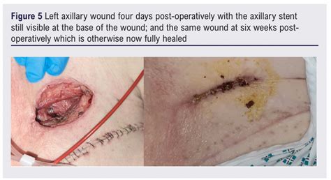 Axillary Endovac Procedure A Novel Hybrid Procedure For An Infected