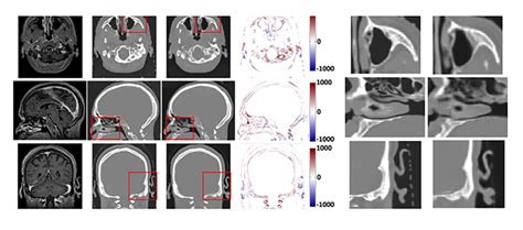 synthetic ct realizing the benefits of mr based treatment planning