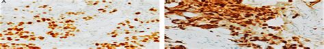 Ki67 Immunohistochemistry Quantification In Breast Carcinoma
