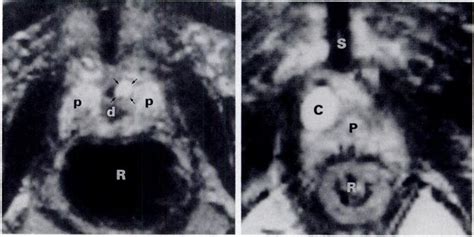 Lateral Prostatic Cyst Transverse Mr Image 2000 50 Cyst Arrows In