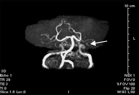 Brain Mr Angiogram With Contrast 3d Time Of Flight Imaging