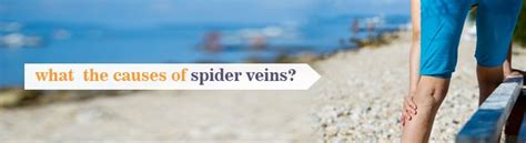 What Are The Causes Of Spider Veins Karishma