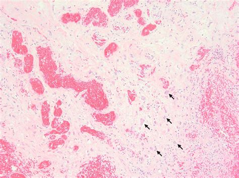 Section From The Bladder Showing Extensive Presence Of Multinucleate Download Scientific