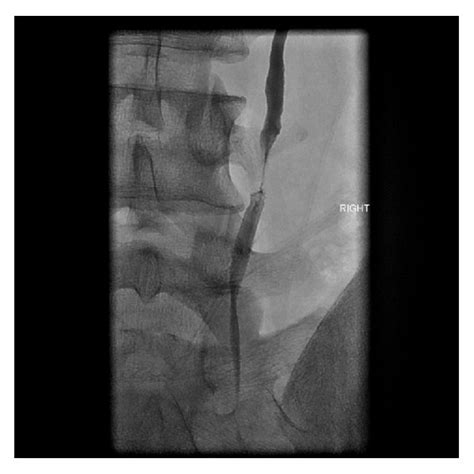 Nephrostogram Demonstrating Midureteral Stricture Download