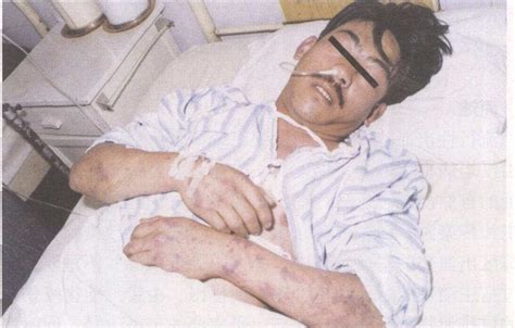 第四节 流行性出血热 常见传染病与性病图谱