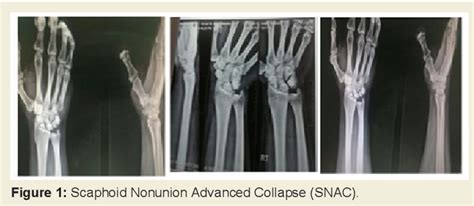 Figure 1 From Scaphoid Excision And Four Corner Fusion Using Anti Grade