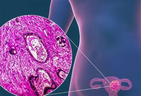 Rahim Kanseri Belirtileri Prof Dr Çağatay Taşkıran