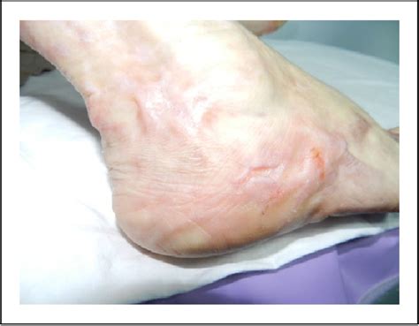 A Case Of Prolidase Deficiency Accompanying Leg Ulcers Semantic Scholar