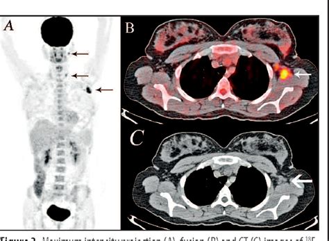 Figure 1 From Kikuchi Fujimoto Disease As A Rare Cause Of Benign