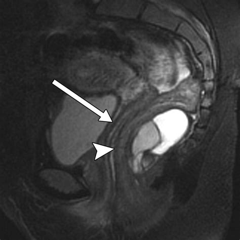 Practical Approach To Mri Of Female Pelvic Masses Ajr