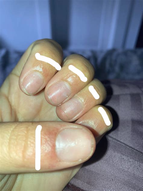 I Have These Bumps And A Rash From Doing My Nails Please Help Rmedicaladvice