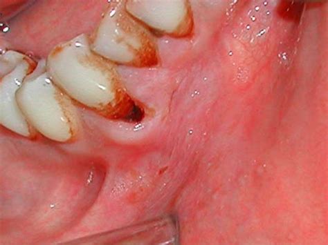 Oral Cavity Cancer