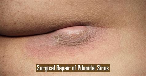 Partial Closure Technique Effective Surgery In Midline Repair Of