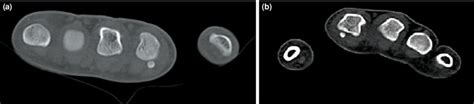 A A Sesamoid Bone Of Mcp Ii Located On Radial Side B Centrally Download Scientific Diagram