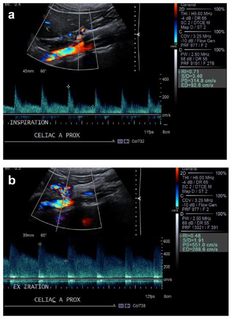 A Doppler Ultrasound Obtained From A Different Patient With Mals