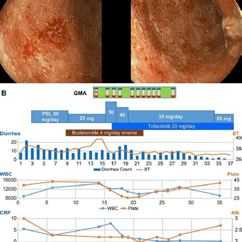A Colonoscopy Performed Before The Treatment Course In Case 2 Showing