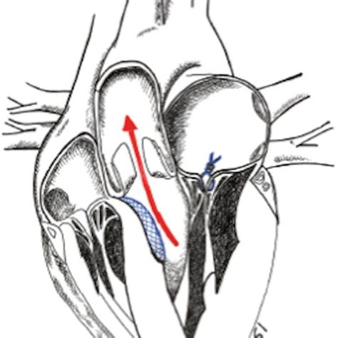 The Transaortic Secondary Chordae Cutting Associated To A Shallow