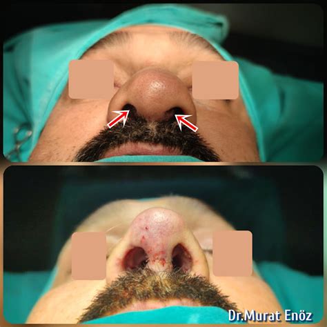 Septal Foreign Body Abscess And Nose Deformity