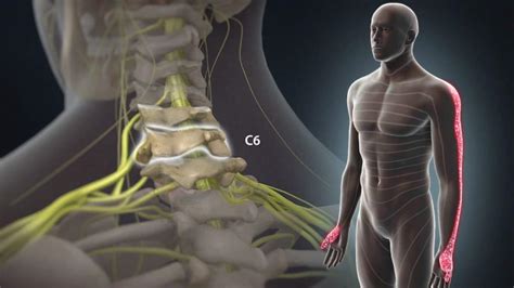 Kode Icd 10 Hnp Cervical Gejala Saraf Kejepit Leher Dan Saraf Kejepit