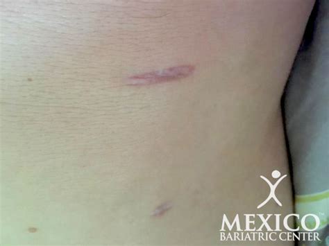 Laparoscopic Gastric Bypass Scars