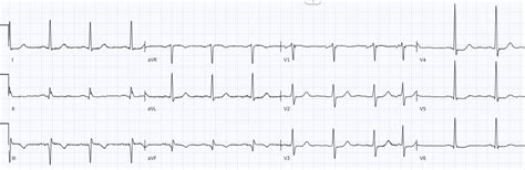 The Ecg In The Diagnosis Of Aortic Dissection Ecg Cases Em Cases