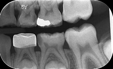caries detection in panoramic dental x ray images at wilford shaw blog