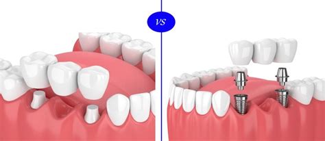 Dental Bridge Vs Implant Cost In 2025 Which Tooth Replacement Option