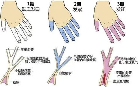 关注系统性硬化症，传递温暖，让爱不罕见！大众健康网