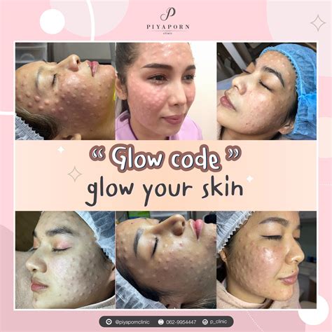 Glow Code บูสผิวแบบเร่งด่วน ซ่อมแซมและฟื้นฟูผิวหน้า มีส่วนผสมเข้มข้นหลักคือ 👉🏻 กรดไฮยาลูโรนิก
