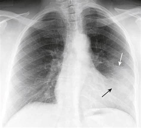 Recognizing Pneumonia Clinical Tree