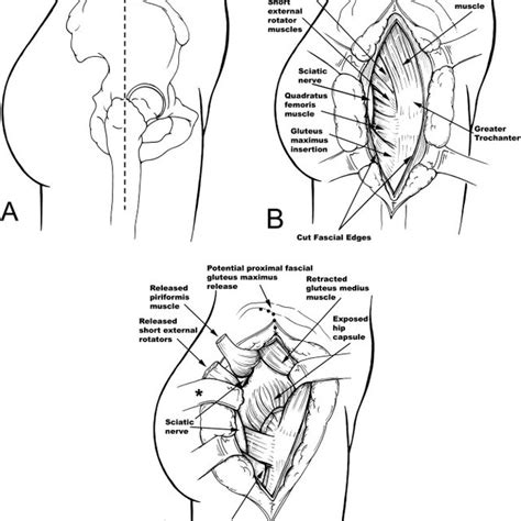 Radiograph Shows Posterior Dislocation Of Hip With Posterior Acetabular