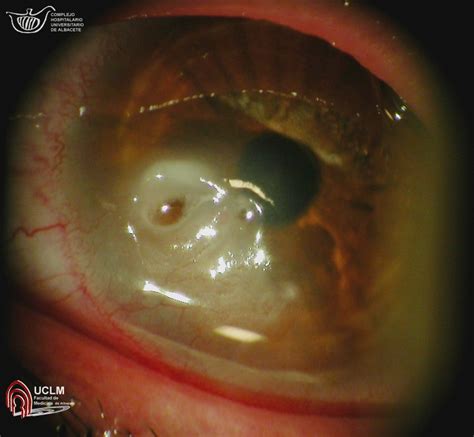Traumatismo Ocular