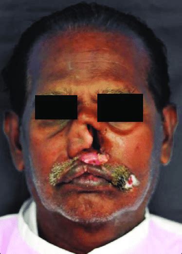 Nasal Defect After Surgical Resection Download Scientific Diagram