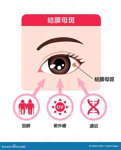 Causes Of Conjunctival Nevus Vector Illustration