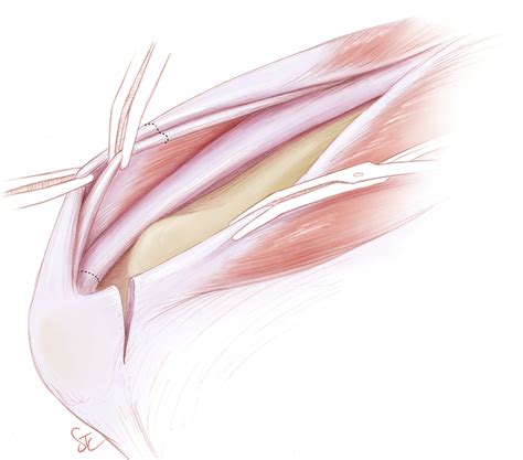 Oblique Lateral View The 3 Layers Of The Quadriceps Tendon