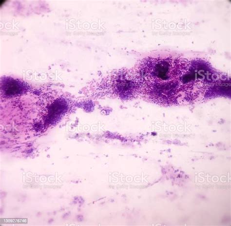 High Grade Squamous Intraepithelial Lesion Photomicrograph Of