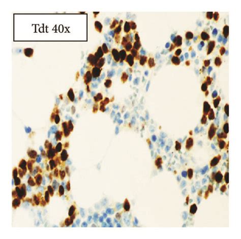 Immunohistochemistry Performed On Bone Marrow Biopsy First Relapse