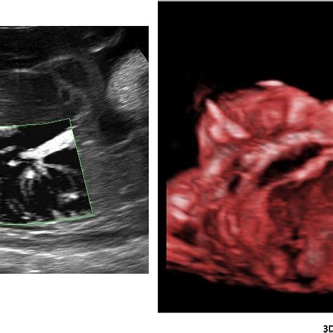 Doppler Ultrasound Image Showing Chorionic Vessels In The Placenta Download Scientific Diagram